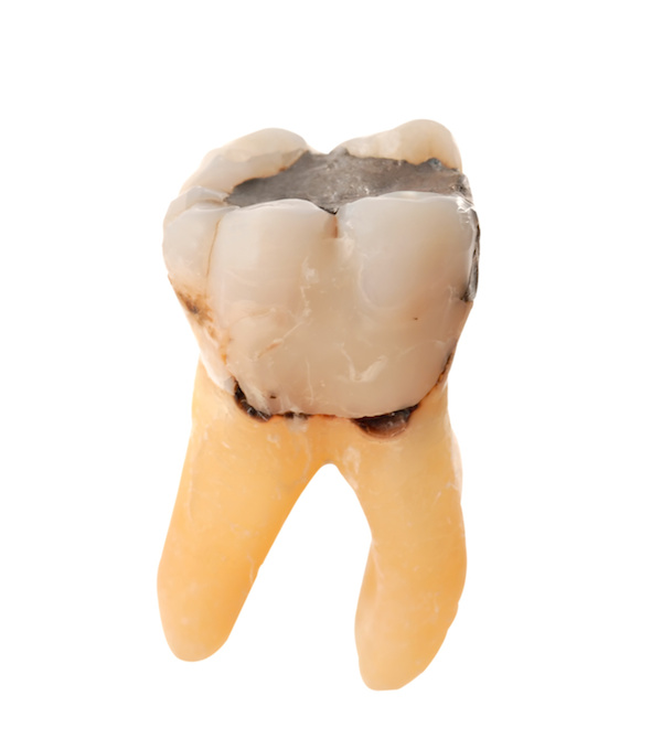 Old filling? We can replace it! - Smiles By Shields Dentistry